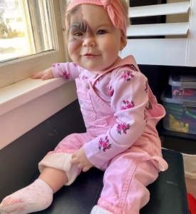 Mom Made It Mission to Show Daughter With Rare Birthmark Her Beauty