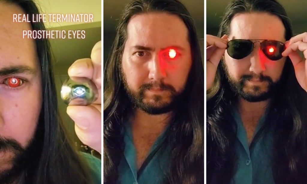 Cancer Survivor Creates Bionic Eye That Looks Like Terminator