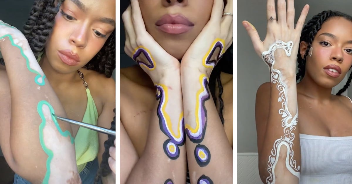 Woman With Vitiligo Transforms Her Skin Into Art Spots